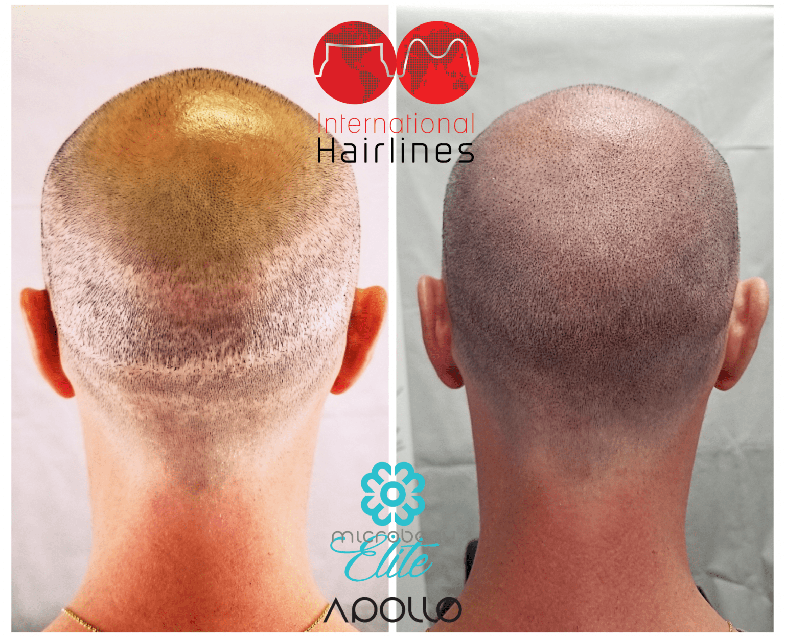 Scalp Micropigmentation for scar camouflaging- International Hairlines