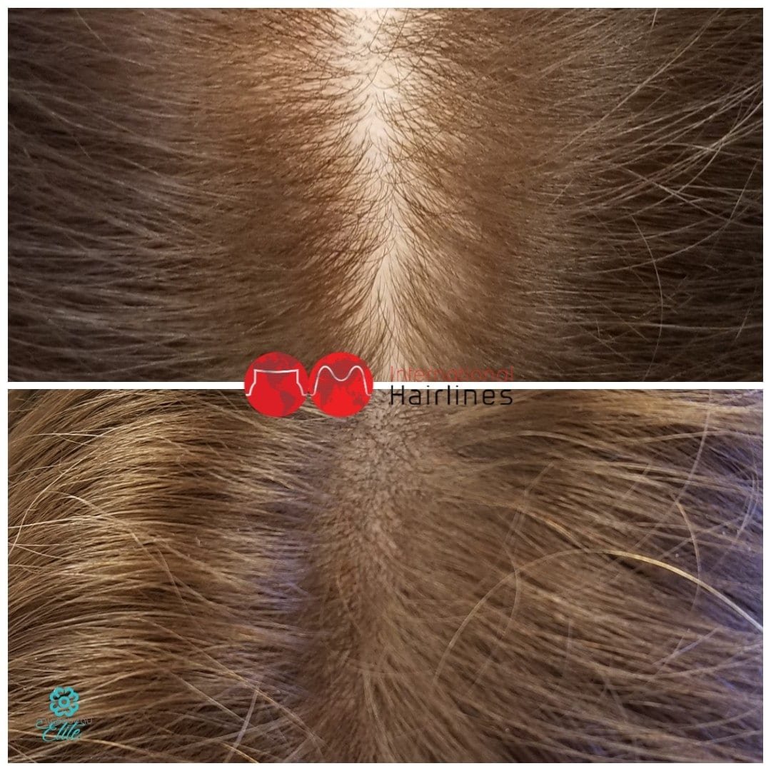 Scalp Micropigmentation For Women - International Hairlines