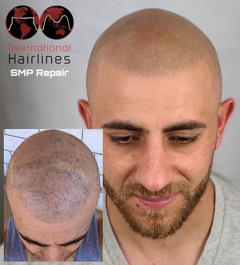 Scalp Micropigmentation Clinic | Hair Loss Solution - International ...