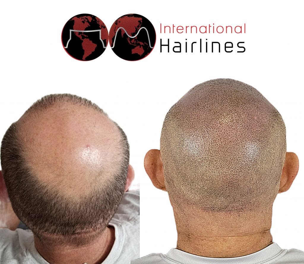 Scalp Micropigmentation Before and After Photos - International Hairlines