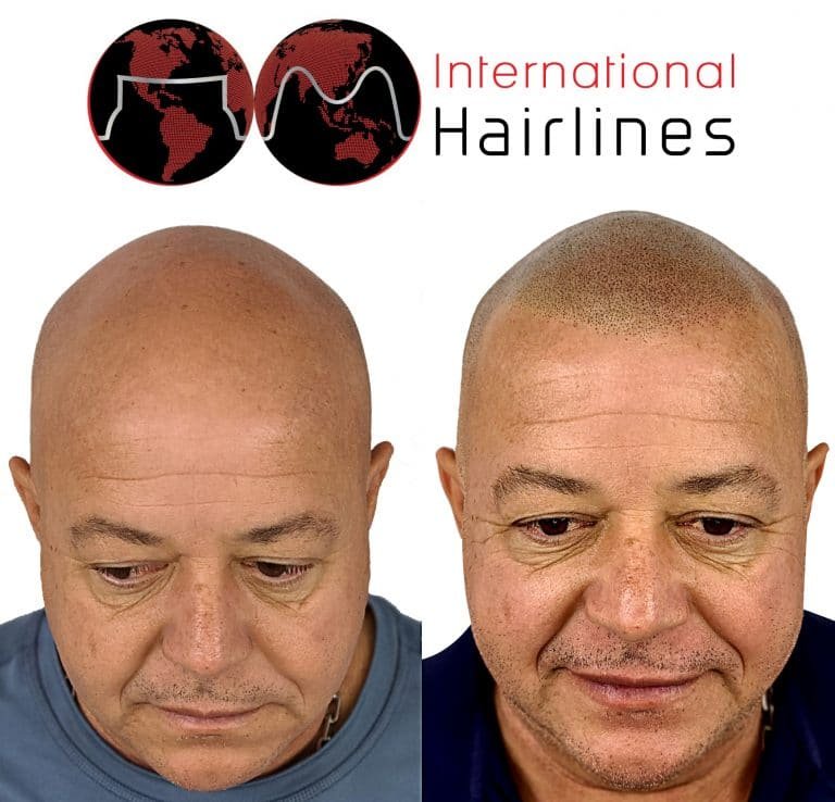 Scalp Micropigmentation Before and After Photos - International Hairlines