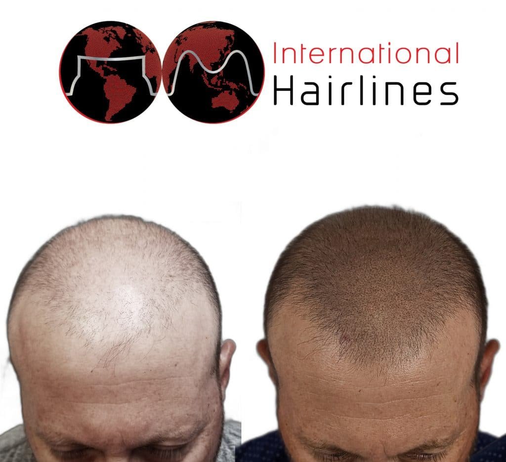 Scalp Micropigmentation Before and After Photos - International Hairlines