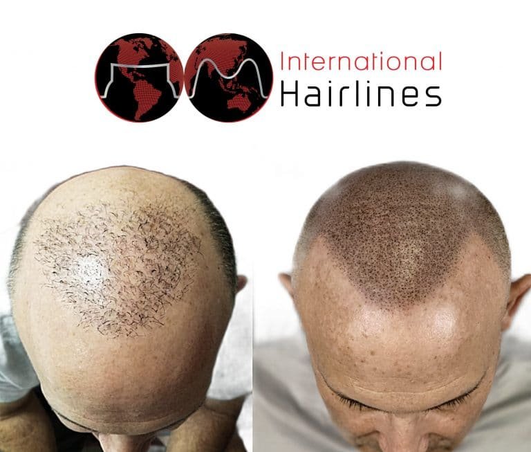 Scalp Micropigmentation Before and After Photos - International Hairlines