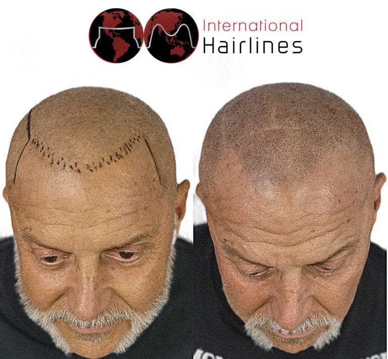 Scalp Micropigmentation Before and After Photos - International Hairlines