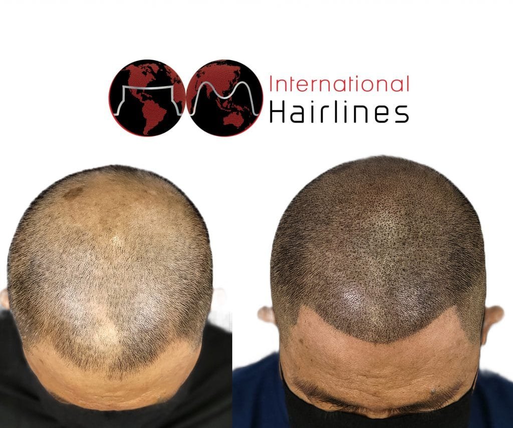Scalp Micropigmentation Before and After Photos - International Hairlines