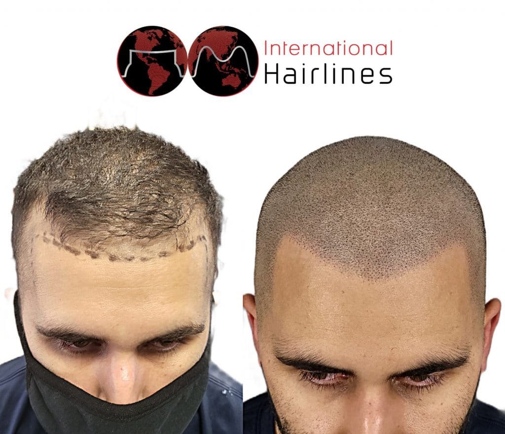 Scalp Micropigmentation Before and After Photos - International Hairlines