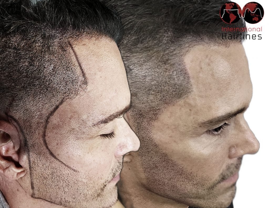 Scalp Micropigmentation Before and After Photos - International Hairlines