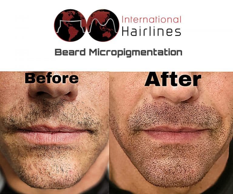 Scalp Micropigmentation Before and After Photos - International Hairlines