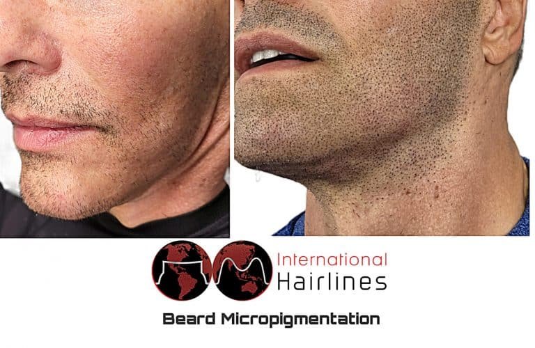 Scalp Micropigmentation Before and After Photos - International Hairlines