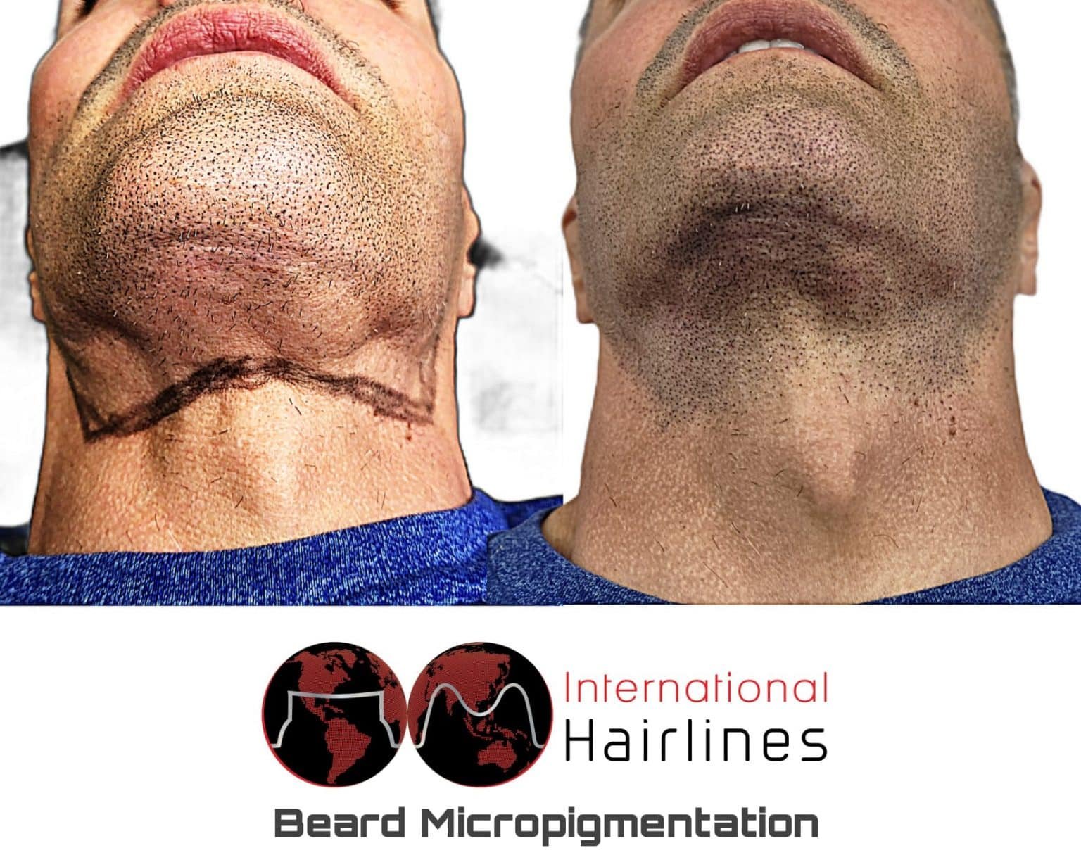 Scalp Micropigmentation Before and After Photos - International Hairlines